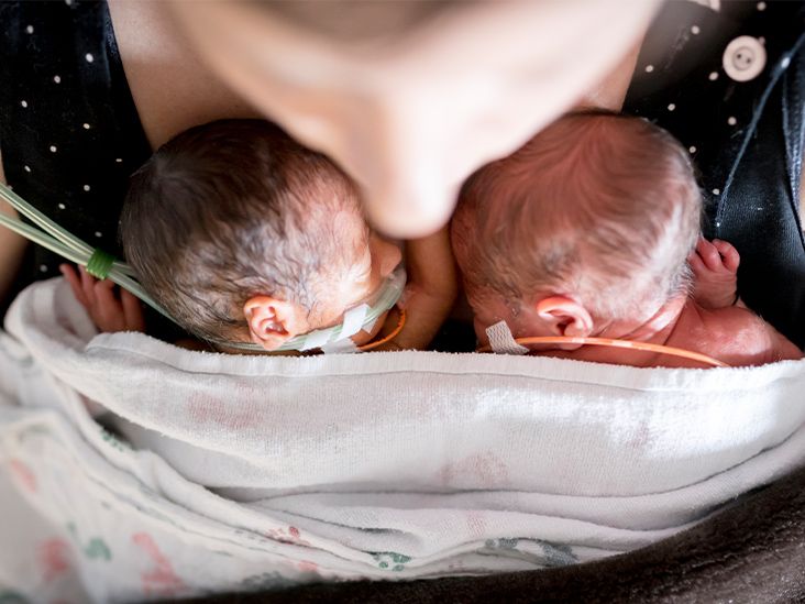 Conjoined Twins: Development, Delivery, and Separation