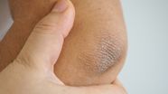 Psoriasis Elbow