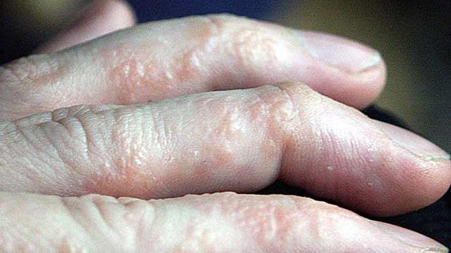 mild eczema types