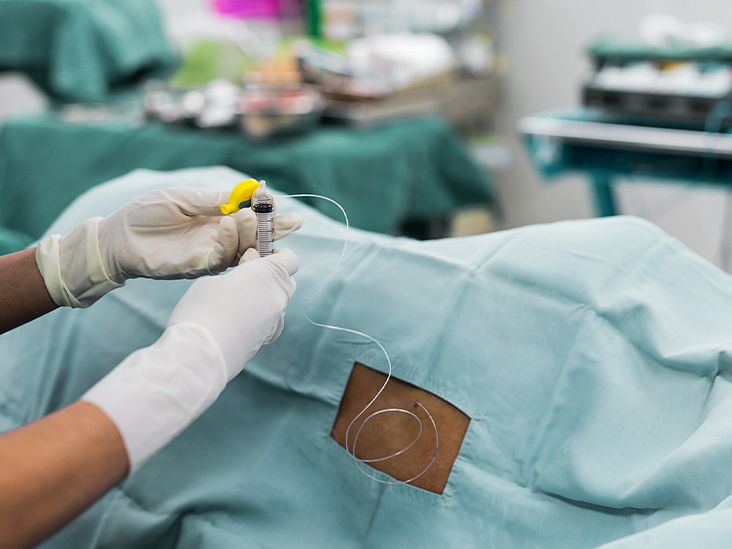 Transforaminal Epidural Steroid Injection (TFESI)