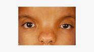 Hypertelorism Fundamentals Of Orbital Hypertelorism And Frontonasal