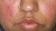 Liver Disease Lips Infoupdate Liver Disease Lips Infoupdate