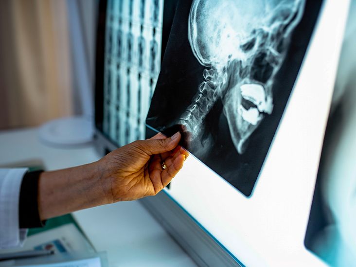 Skull Xray Causes Symptoms Treatment Skull Xray