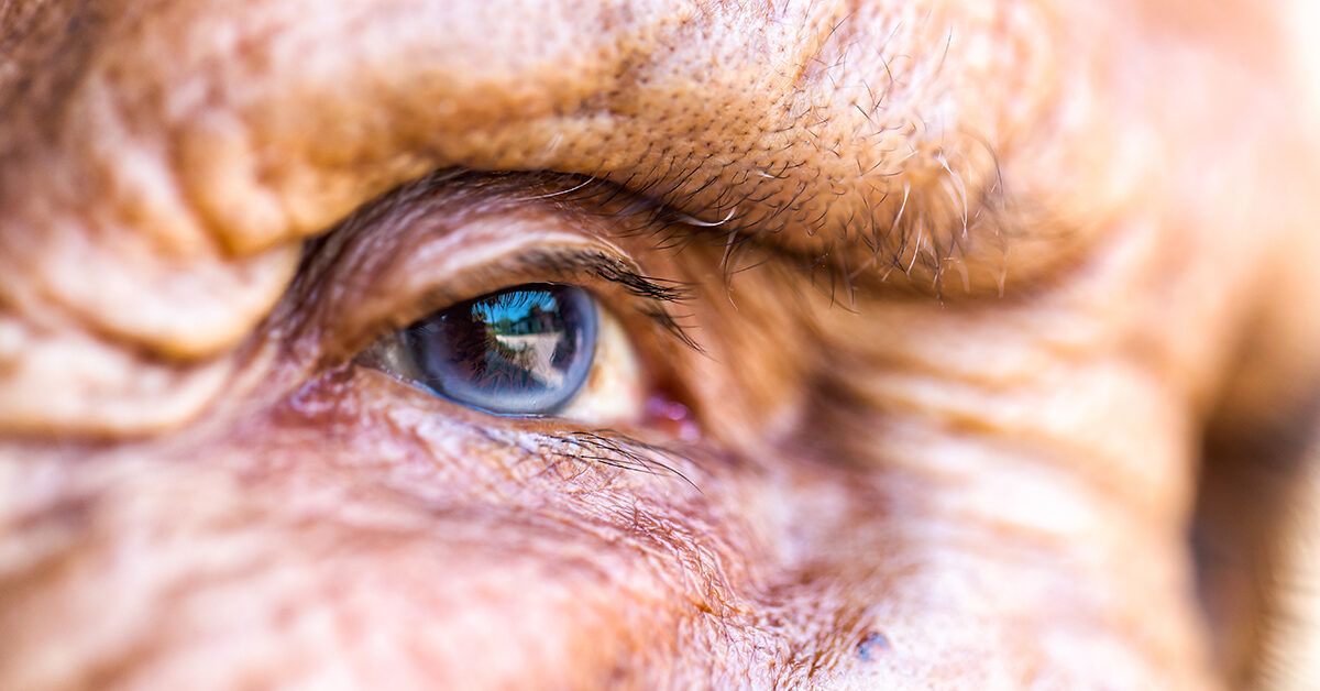 Cortical Cataract: Causes, Symptoms, Treatment, and More