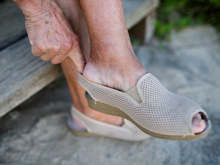 What Does Psoriatic Arthritis Look Like?