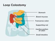Loop Colostomy Reversal