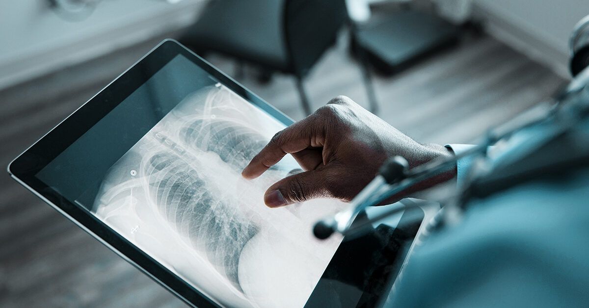 Pulmonary MALT Lymphoma: Symptoms, Treatment, Outlook