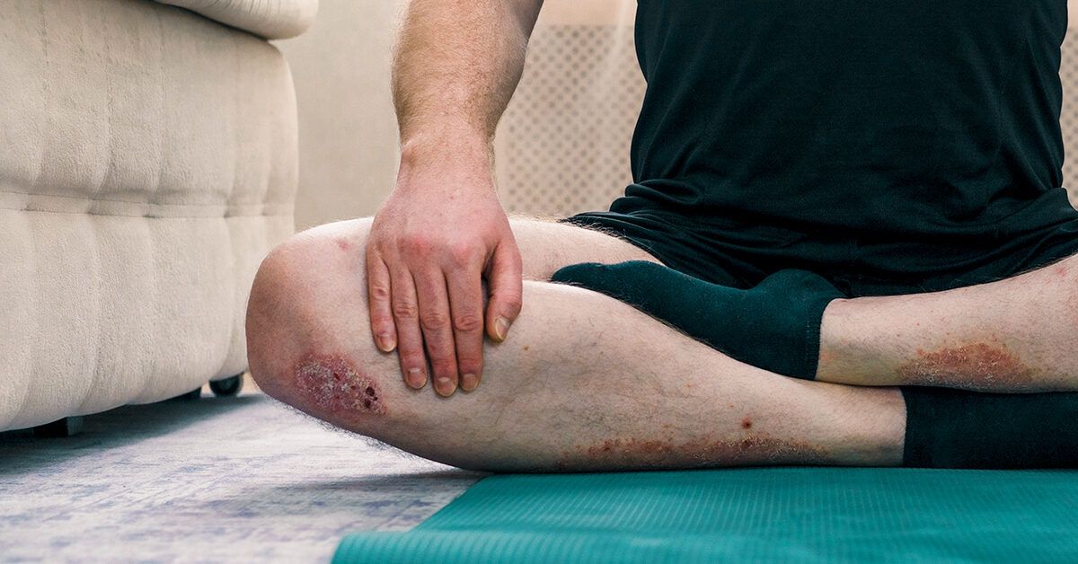 Psoriasis and Liver Disease: What's the Link?