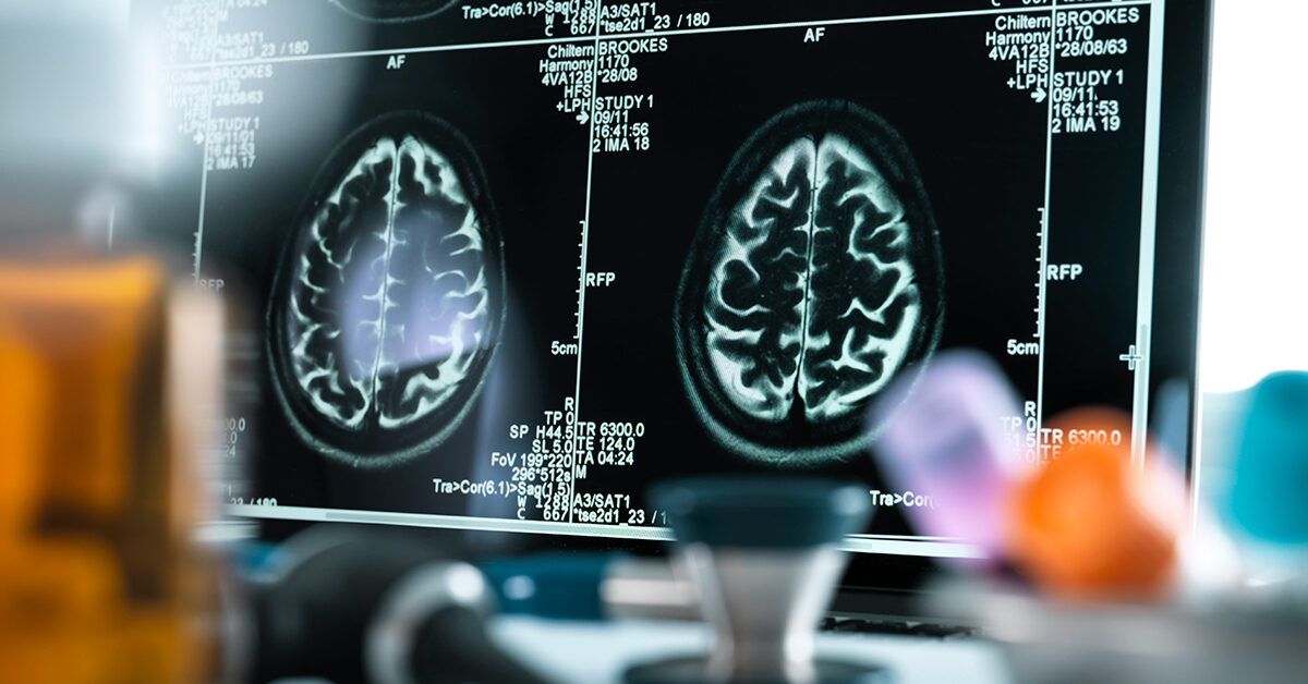 Secondary Central Nervous System (CNS) Lymphoma