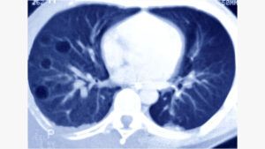 Emphysema Diagnosis Ct Scan