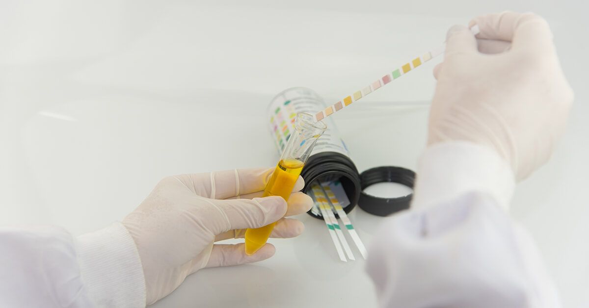 Urine Protein-Creatinine Ratio Test: What It Measures, Levels