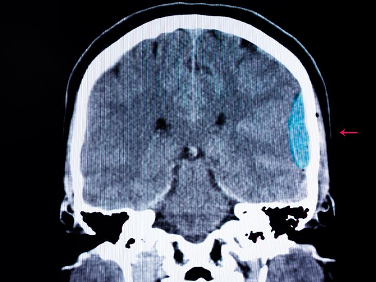 Brain Hemorrhage: Causes, Symptoms, Treatment, Outlook