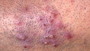 Cine For Ingrown Hair Cyst To Go Away - Infoupdate.org