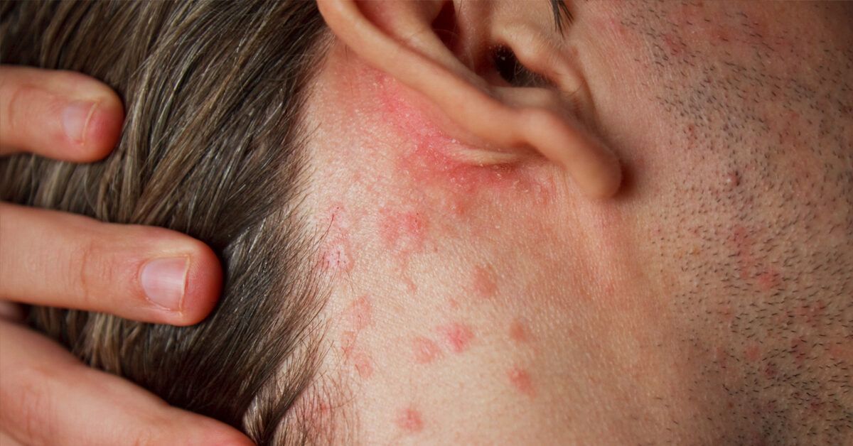 Coping with Psoriasis and RA: Ask the Advocate