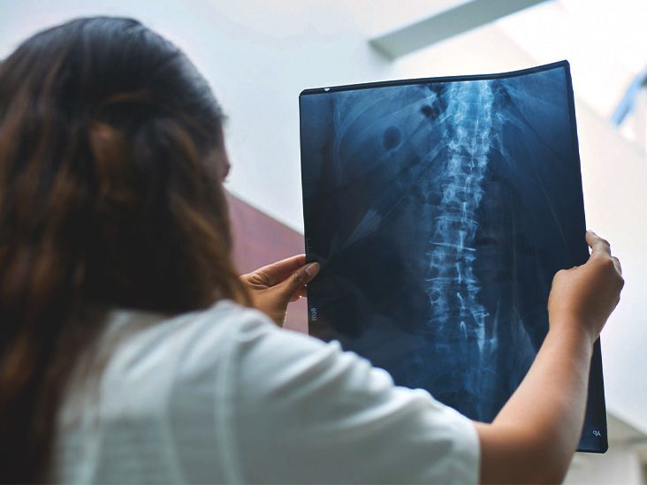 How Osteoporosis and Degenerative Disk Disease Are Related
