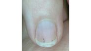 Thin Black Line Under Skin On Foot Store Emergencydentistry