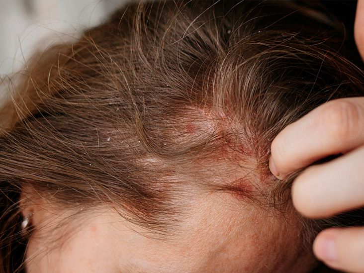 Mild Psoriasis: Pictures, Types, and Symptoms