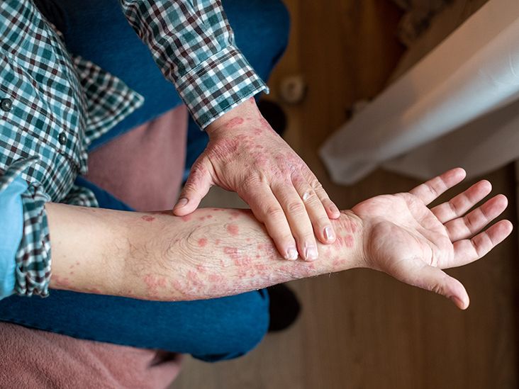 Psoriasis Treatment Timeline: Your FAQs Answered