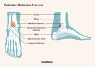 Medial Malleolus Fracture Medial Malleolus Fracture