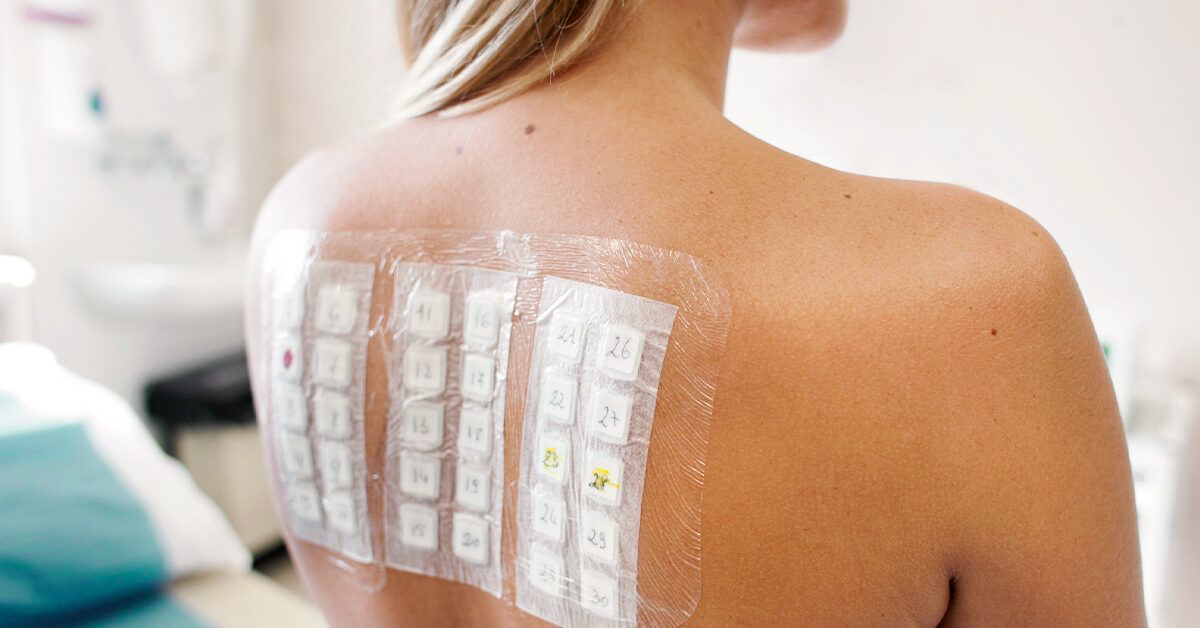 Eczema Skin Patch Test: Procedure and Possible Side Effects