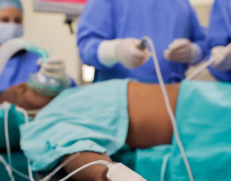 Laparoscopic Colostomy: Candidates, Procedure, Recovery, More