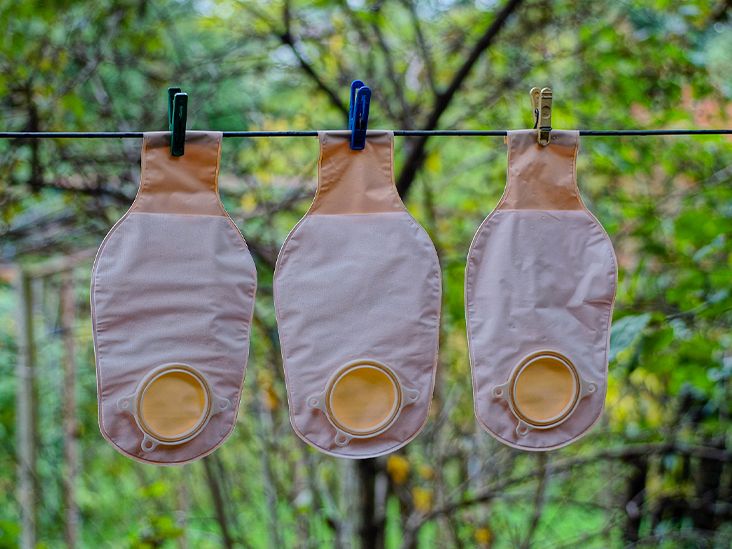 Ileal Conduit vs. Urostomy: What’s the Difference?