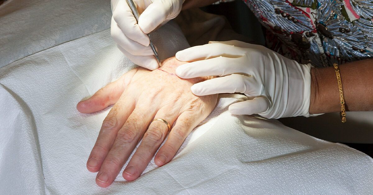 Melanoma Surgery: Procedure, Different Types, and Recovery