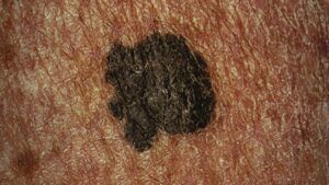 Can Mild Dysplastic Nevus Become Melanoma Dog - Infoupdate.org