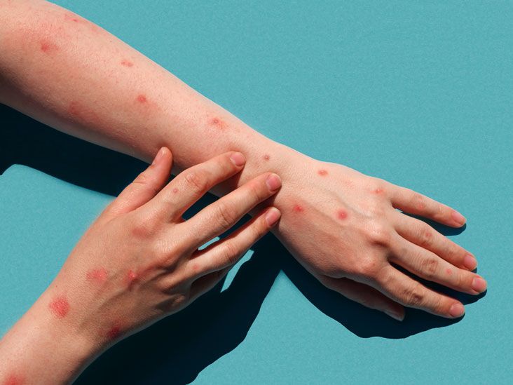 Hives vs. Monkeypox: Tips for Identification, Diagnosis, and More