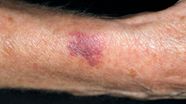 Senile Purpura Purpura UF Health