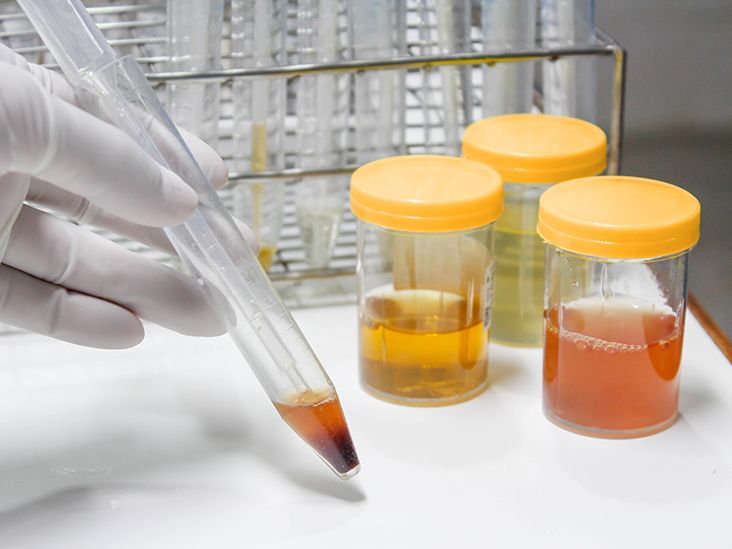 Urine Color in Kidney Failure: Changes to Watch For