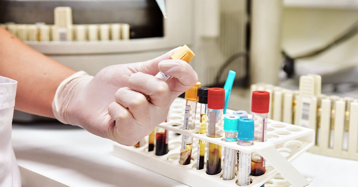 Lupus and Low Platelets: Symptoms, Treatment, and Outlook