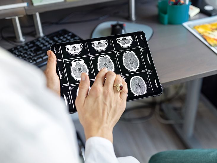 Parafalcine Meningioma: Causes, Symptoms, and Treatment Options