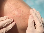 Lymphoma Disease