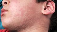 Itchy Rash On Face Itchy Rash On Face