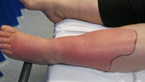 Cellulitis And Edema Difference - Infoupdate.org