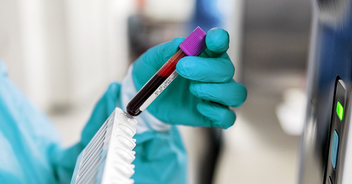 Hemolytic Anemia CBC Results: RBC, Hemoglobin, MCV, More