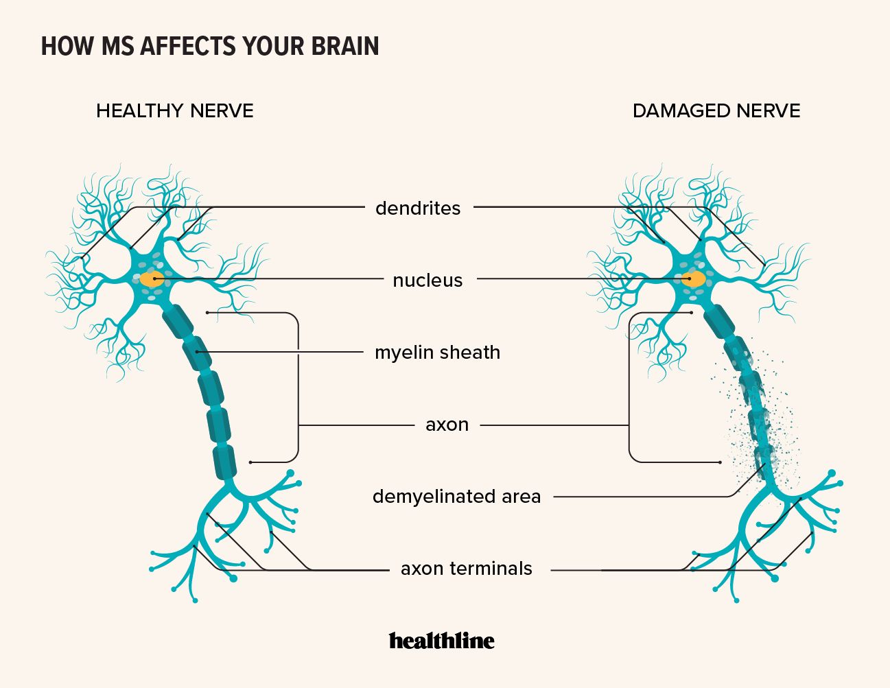 Multiple Sclerosis: Effects on the Brain