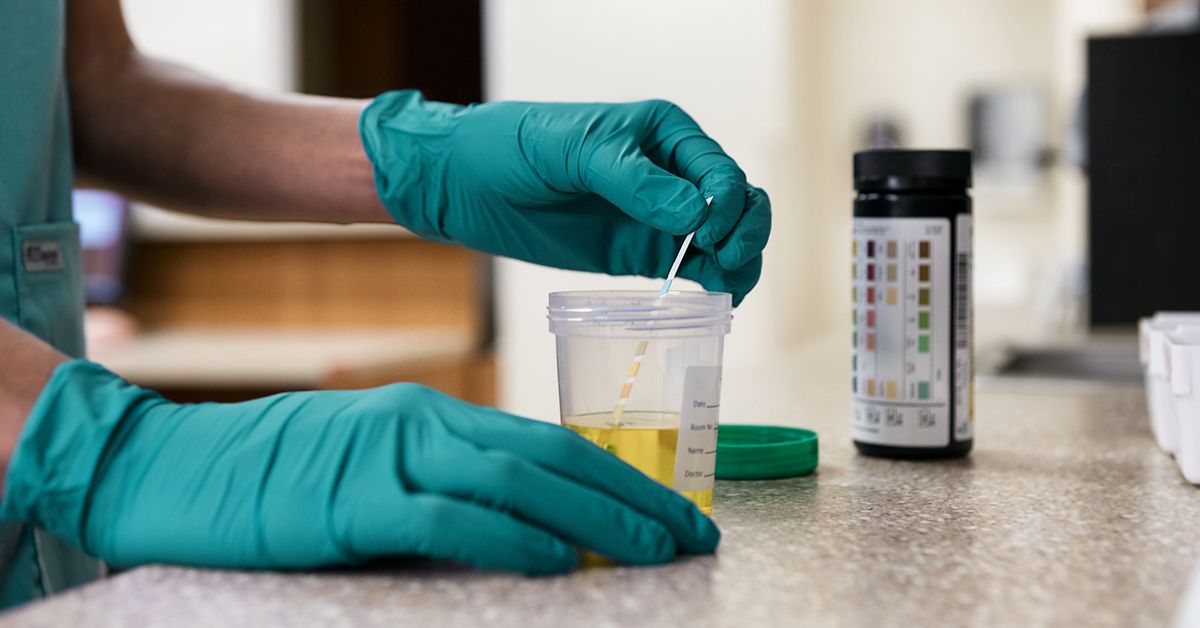 What Is A Urine Glucose Test? Uses and Diagnoses