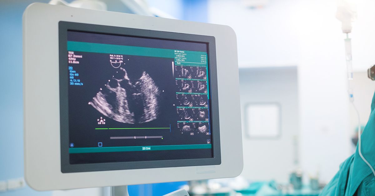 Tricuspid Regurgitation Echo: Use for Diagnosis, Management