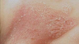 Genital Bumps Female Vulvar Acne (Vaginal Pimples) ? Here's What You