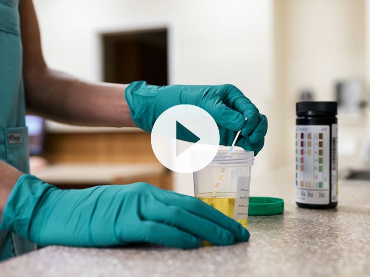 What Is A Urine Glucose Test? Uses and Diagnoses