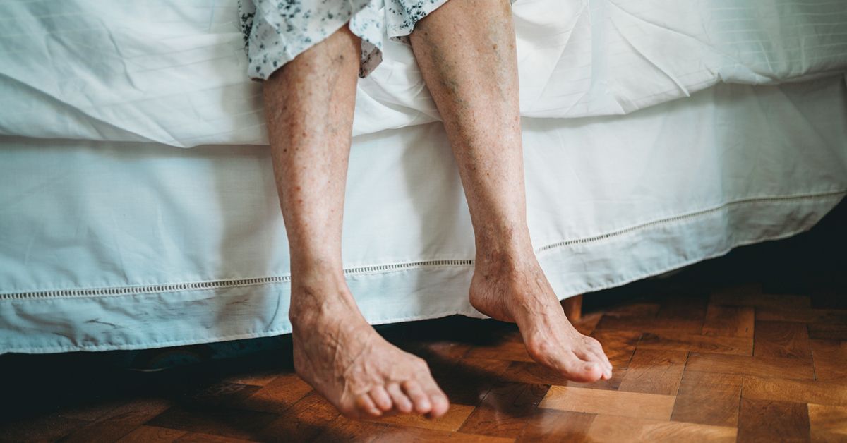 Polycythemia Leg Pain: Treatment and Prevention
