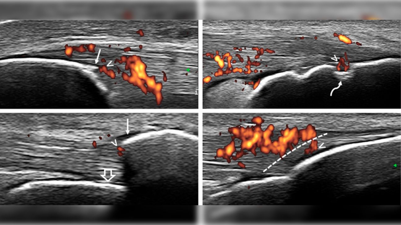 Psoriatic Arthritis Radiology: Types, Features, and Pictures