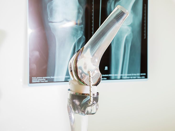 "Knee Replacement Implants: How to Choose What's Right for You