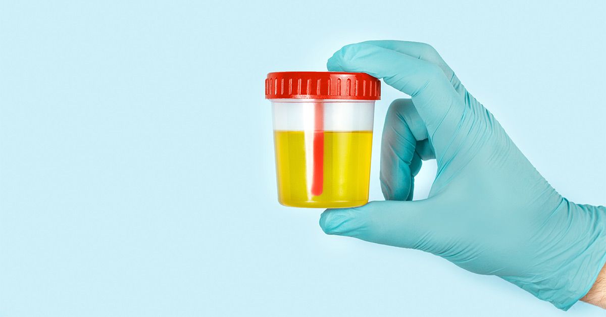 Prostate Cancer: New Urine Test May Help Reduce Unnecessary Biopsies