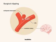 Intracranial Aneurysm Nonruptured Cerebral Aneurysm What You Need To Intracranial Aneurysm Nonruptured Cerebral Aneurysm What You Need To