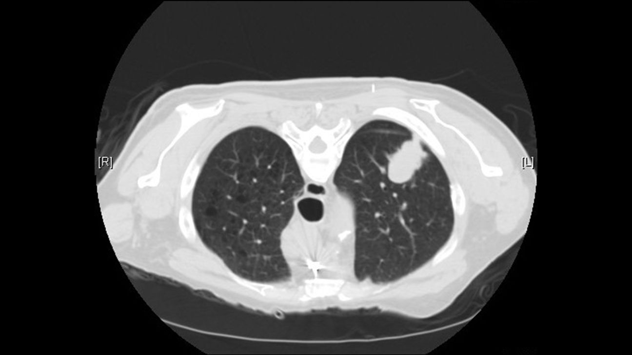 Lung Cancer Chest X Ray Wikidoc UC San Diego's Practical Guide To