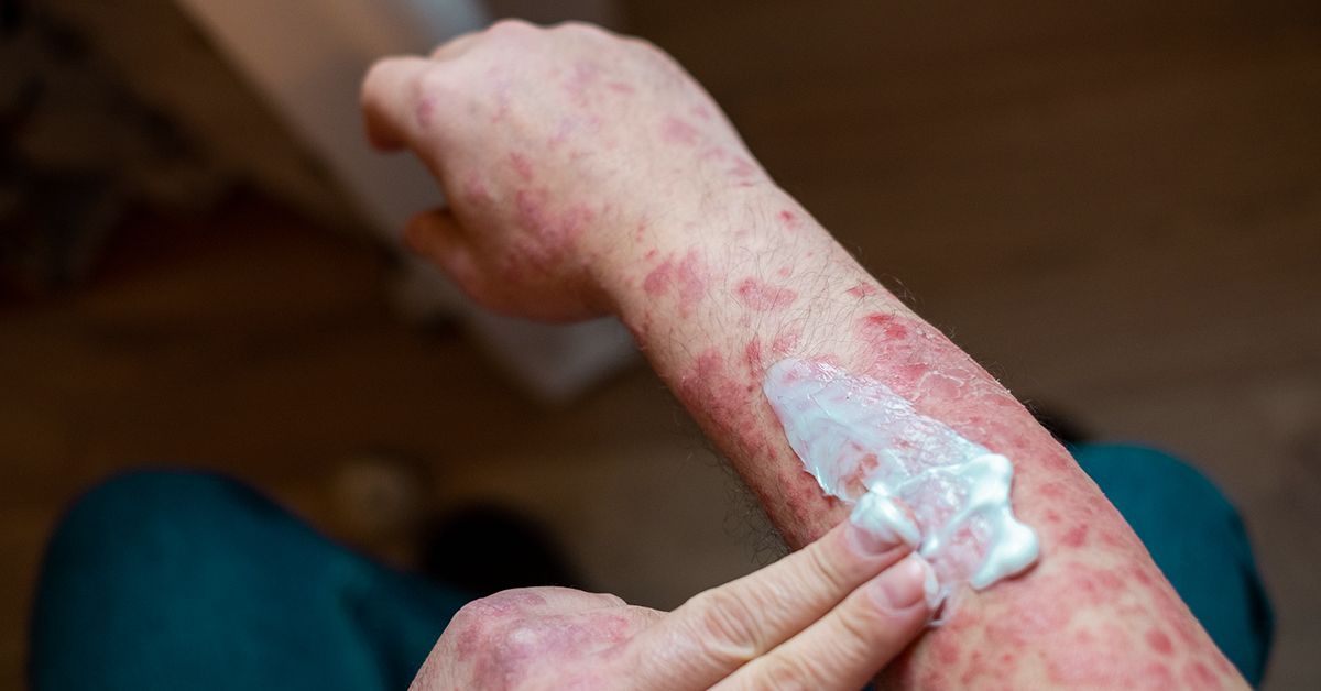 Psoriatic Arthritis and Lymphoma: Is There a Link?