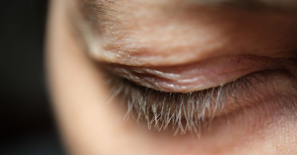 Basal Cell Carcinoma on Eyelid: Symptoms, Treatment, Outlook